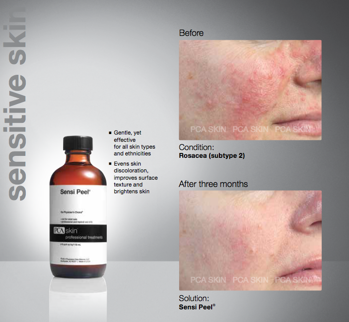 PCA Skin Peel Treatments — Sharon Gordon SKIN