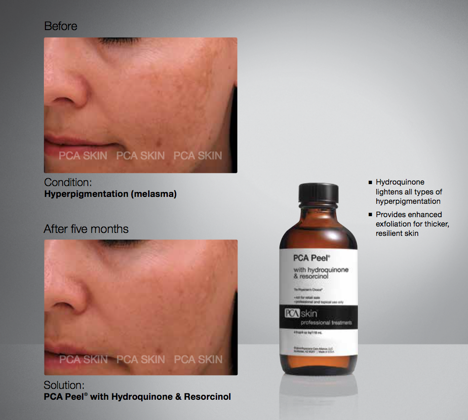 PCA Skin Peel Treatments — Sharon Gordon SKIN