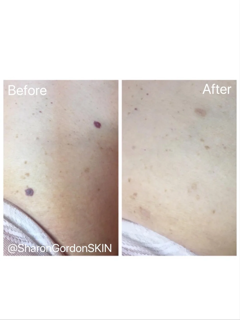 Cherry Hemangioma Removal