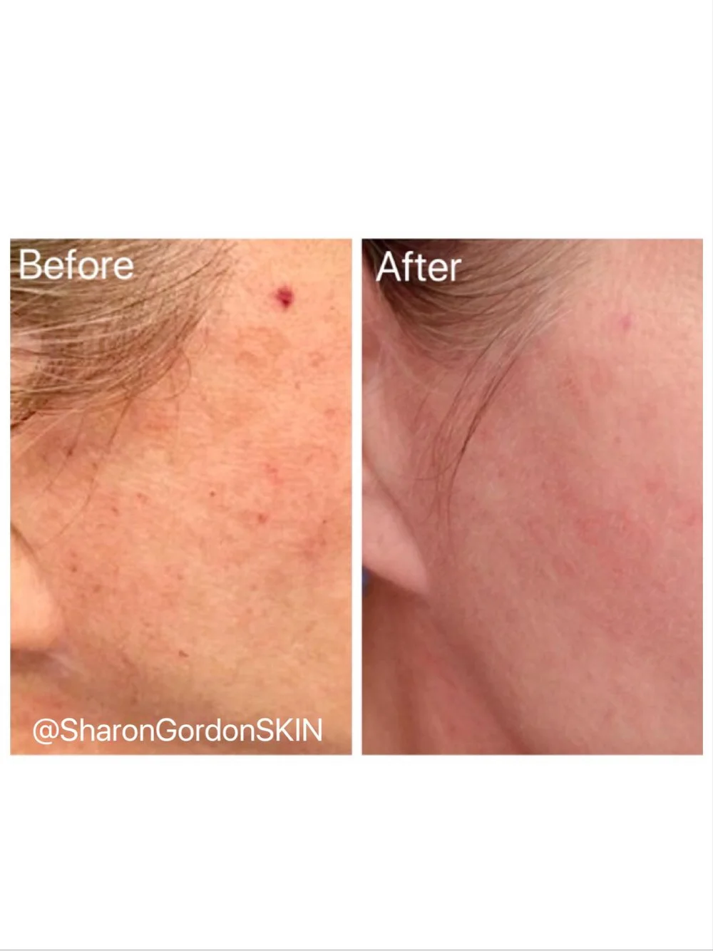 Cherry Hemangioma Removal