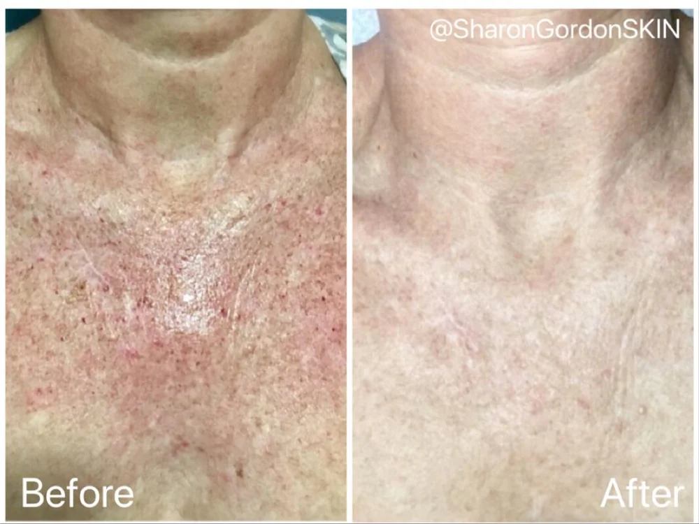 Telangiectasia Chest