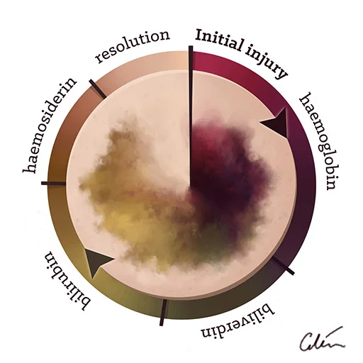 The ‘black’ eye — artibiotics