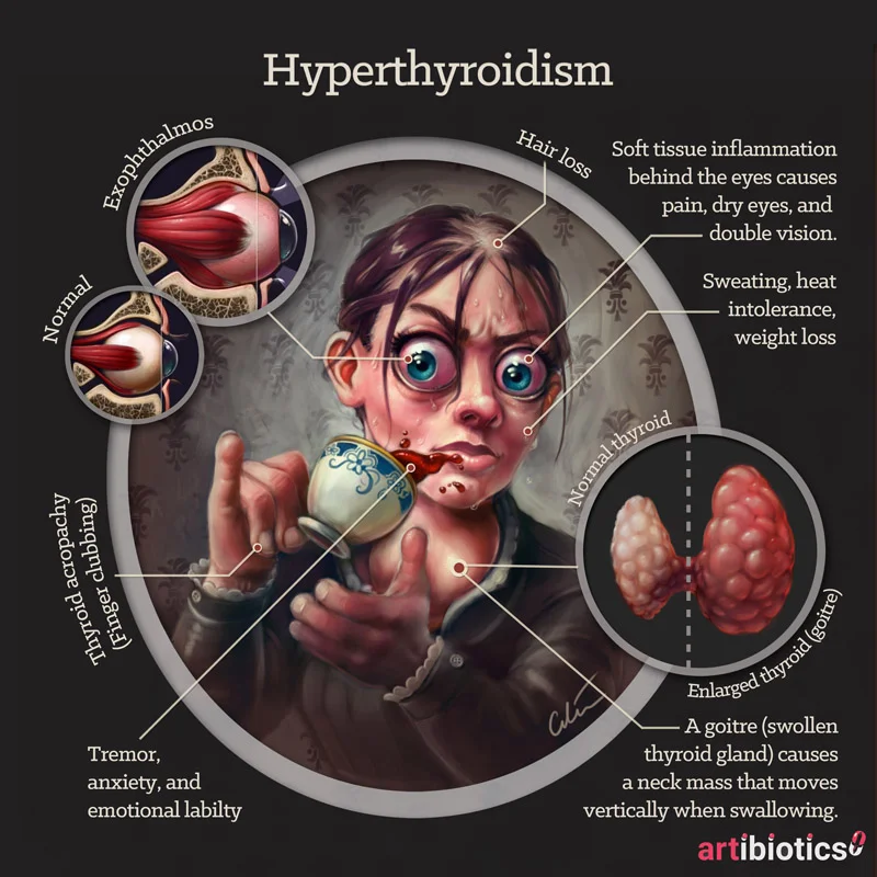 What Can Mimic Hyperthyroidism at Crystal Twyman blog