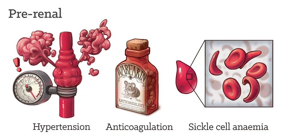 Causes of blood in the urine (haematuria) — artibiotics