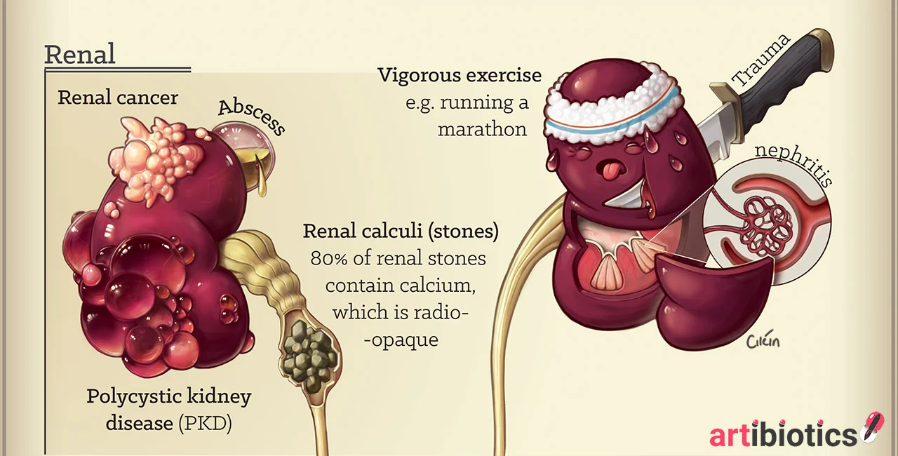 Causes of blood in the urine (haematuria) — artibiotics