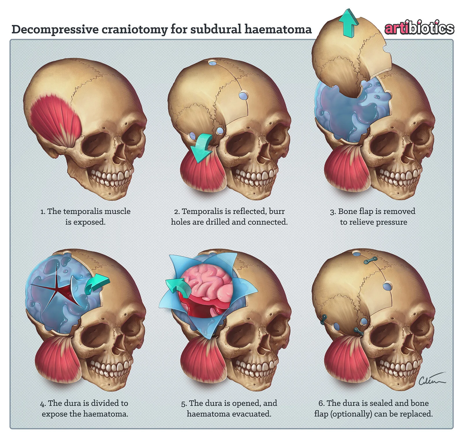 The 'art' of surgical consent — artibiotics