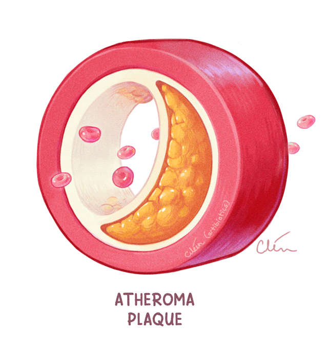 Atheroma — artibiotics