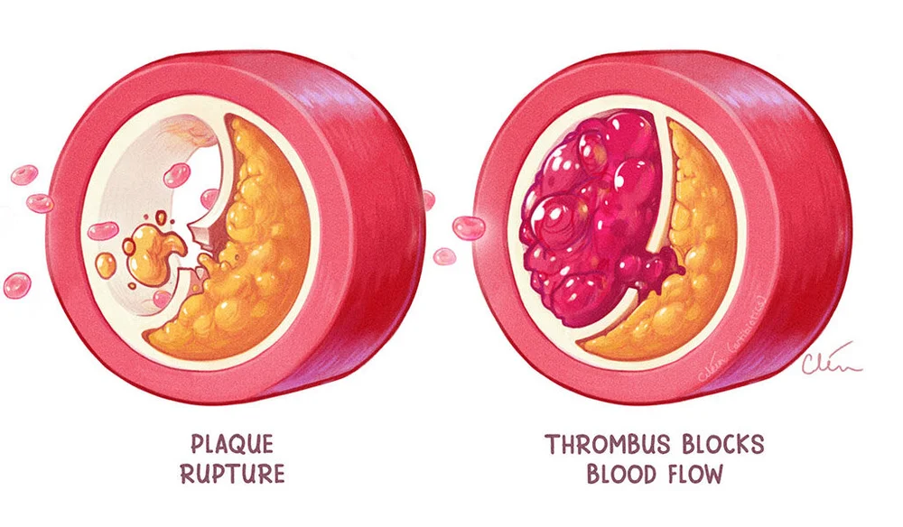 Atheroma — artibiotics