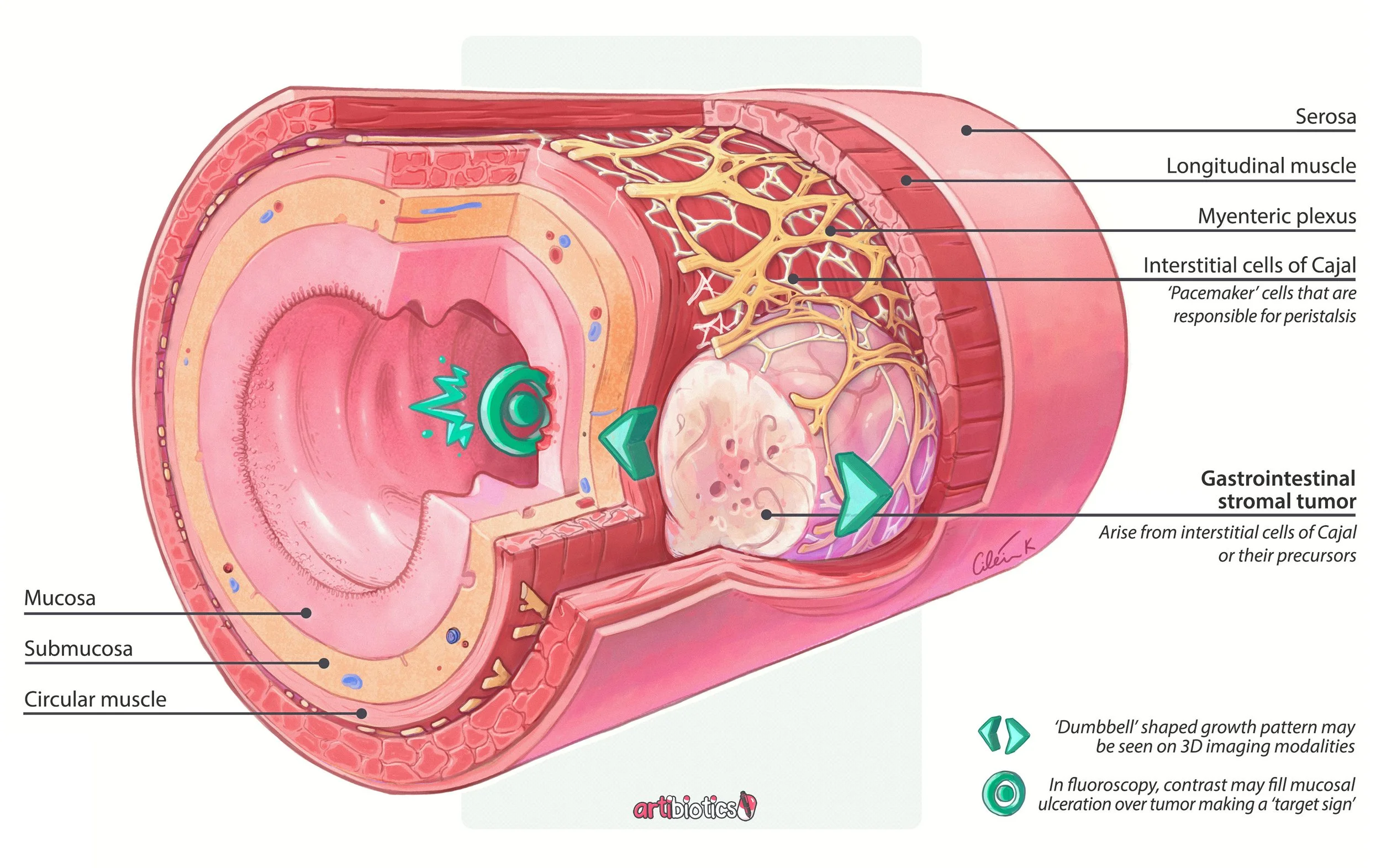 Gastrointestinal Stromal Tumors And Their Appearance In Patients With