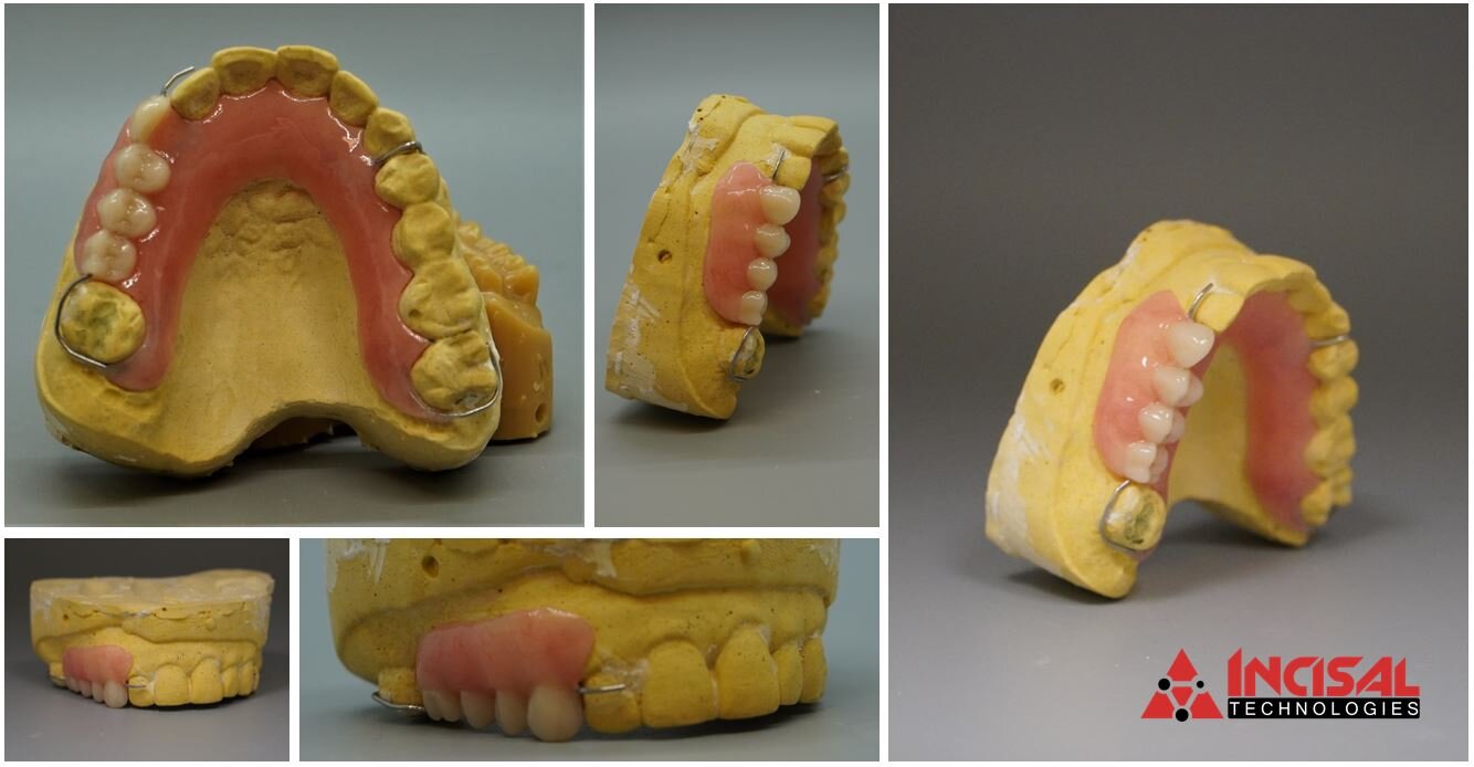 Acrylic Flipper with Wrought Wire Clasps — Incisal Technologies Premier ...