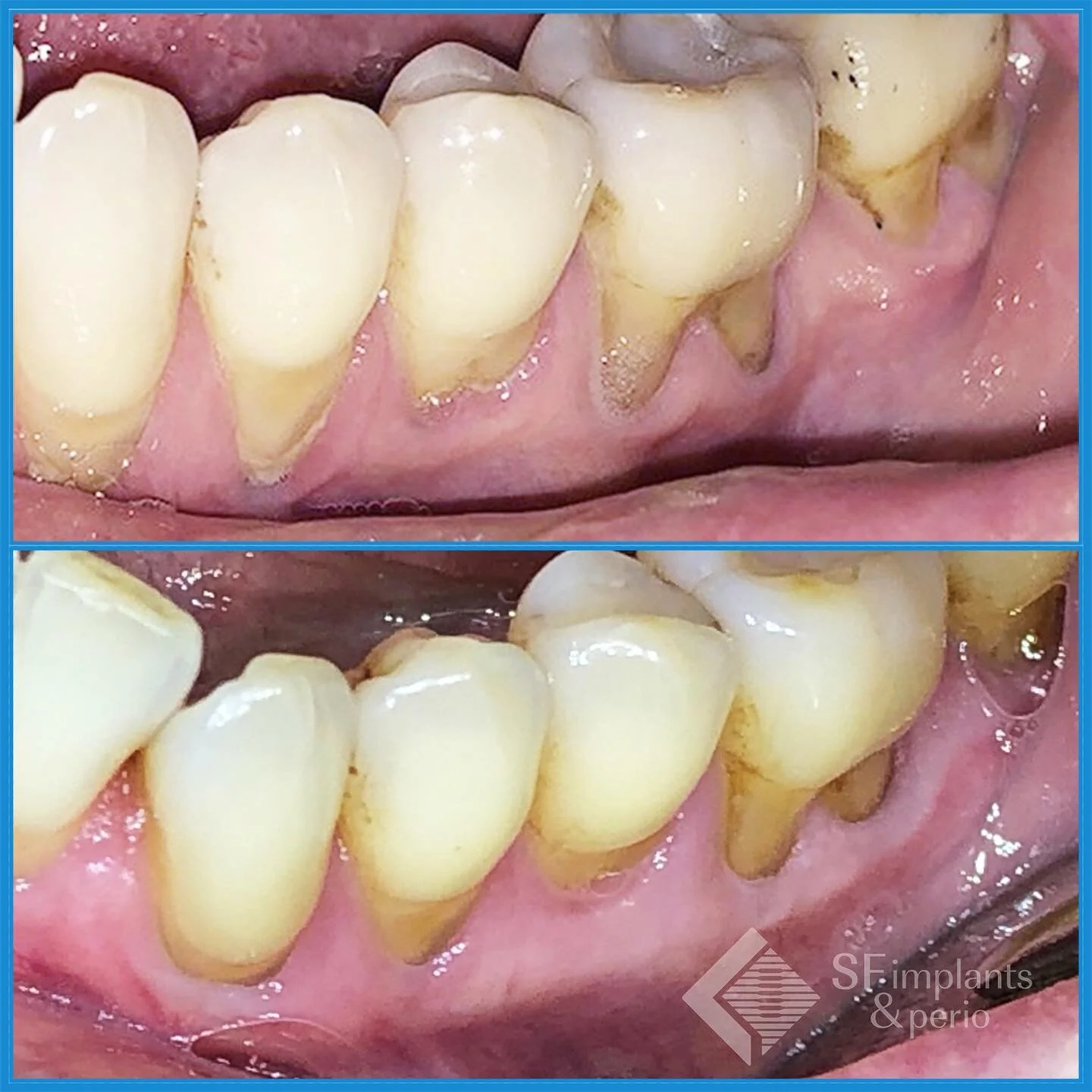 Instagram — SF Implants and Perio | Dr. Terry Im and Associates | (415 ...