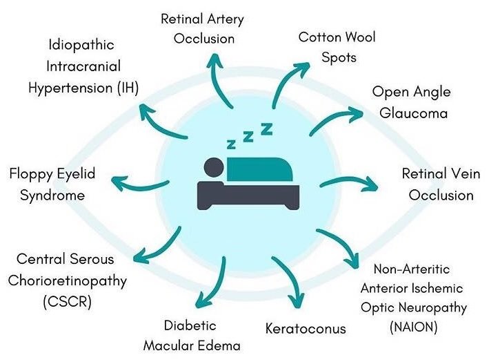 Discover the Surprising Link Between Sleep Apnea and Your Eye Health ...