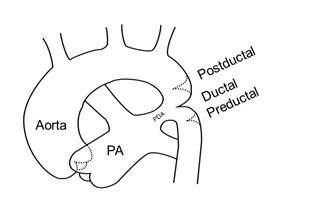 Coarctation of Aorta — The Children's Hospital at Montefiore