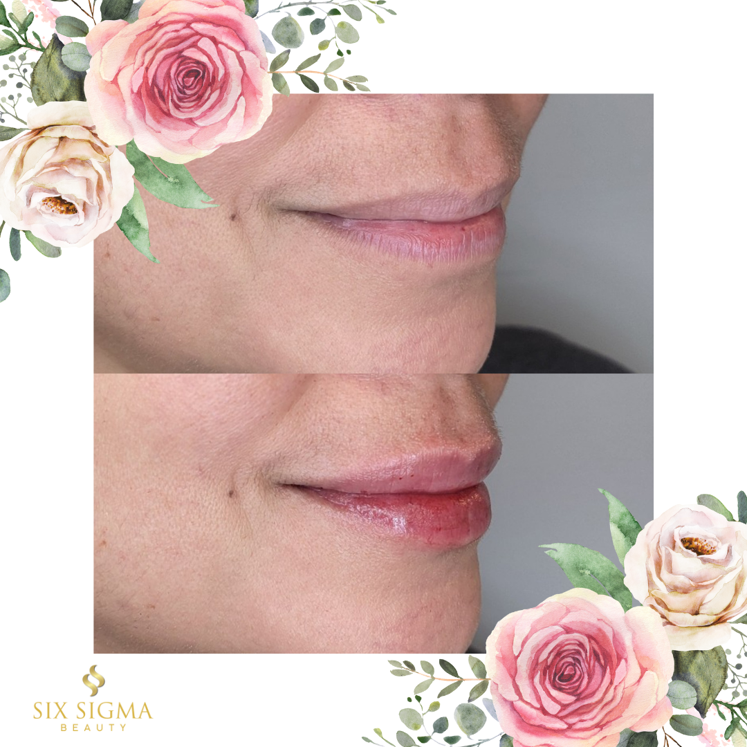 XOXO Lips Filler — SIX SIGMA BEAUTY