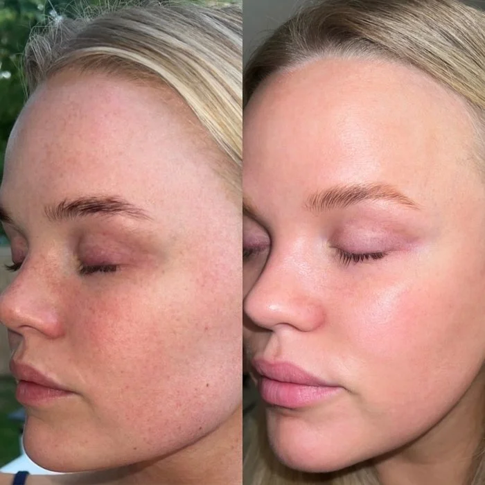 Skin Rejuvenation with LaseMD ULTRA ANTI-AGING LASER — SIX SIGMA BEAUTY