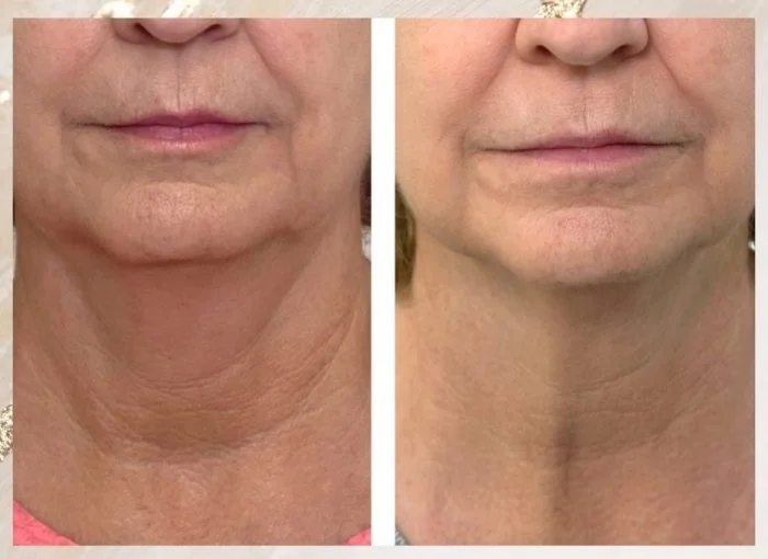 Skin Rejuvenation with LaseMD ULTRA ANTI-AGING LASER — SIX SIGMA BEAUTY