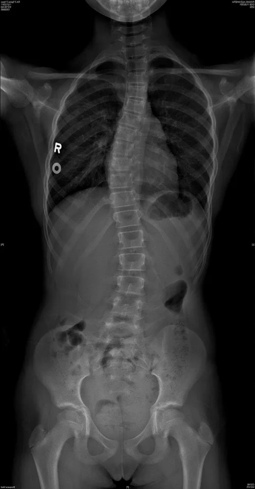 How to Read & Interpret Scoliosis X-Ray Reports — Lyons Structural ...