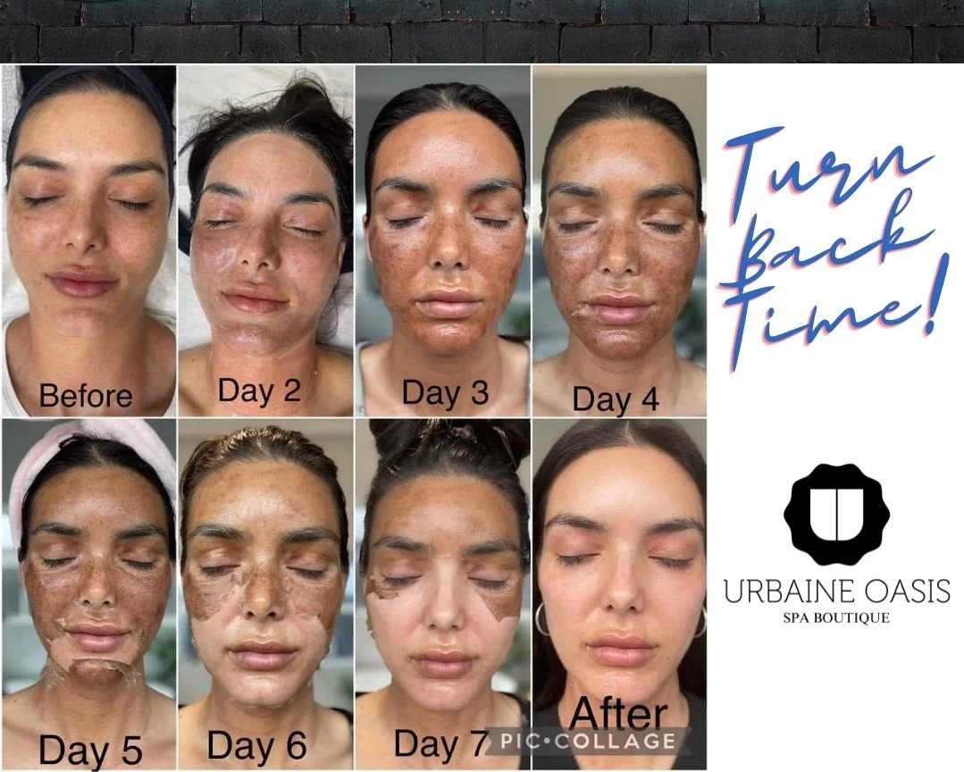 Peeling Treatment
