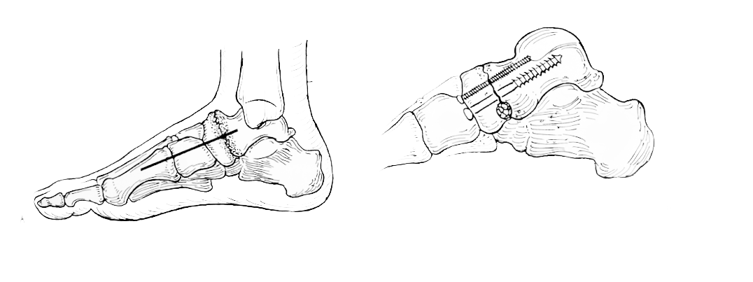 Navicular-Cuneiform Joint Fusion — South West Foot Surgery