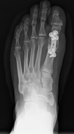1st MTP Fusion — South West Foot Surgery