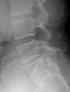 ALIF — Watkins Spine