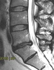 ALIF — Watkins Spine