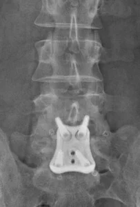 ALIF — Watkins Spine