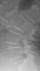 XLIF/DLIF — Watkins Spine