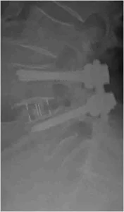 XLIF/DLIF — Watkins Spine