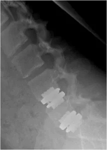 LUMBAR ARTIFICIAL DISC REPLACEMENT — Watkins Spine