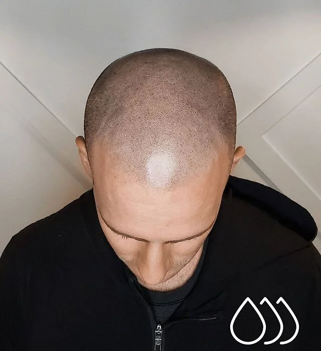 INKBARBER Home INKBARBER - VANCOUVER'S SCALP MICROPIGMENTATION LEADERS