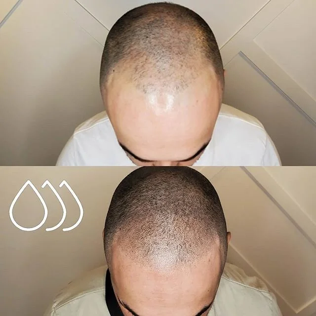 Inkbarber Home Inkbarber Vancouver S Scalp Micropigmentation Leaders