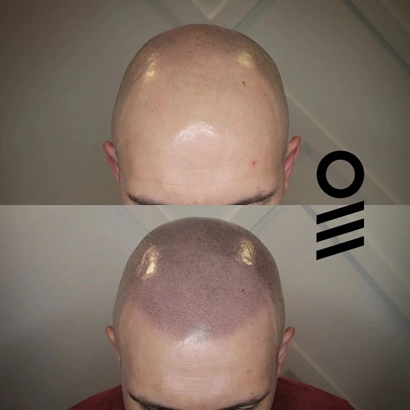 Inkbarber Home Inkbarber Vancouver S Scalp Micropigmentation Leaders