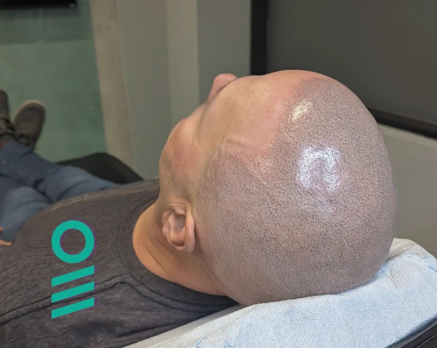 INKBARBER Home INKBARBER - VANCOUVER'S SCALP MICROPIGMENTATION LEADERS