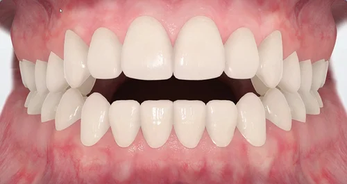 Does Tongue Thrusting Create Anterior Open Bites? | Jorgensen ...