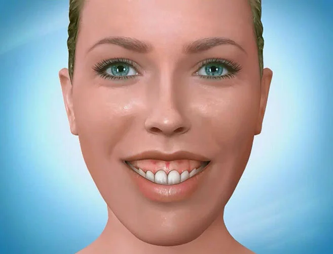 What Causes a Gummy Smile and How Can It Be Fixed? | Jorgensen ...