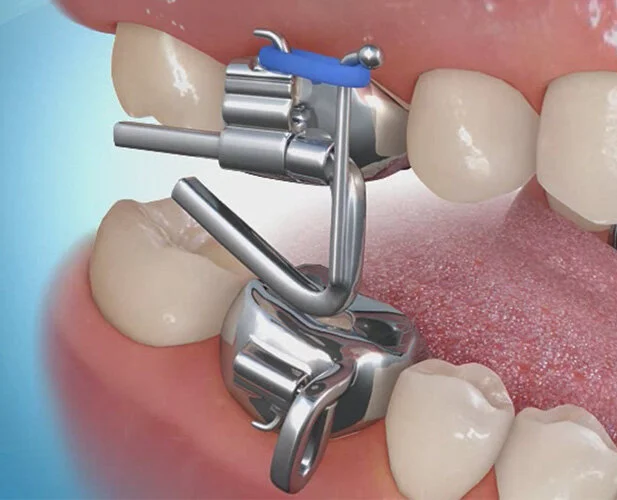What is the MARA Appliance? | Jorgensen Orthodontics - Affordable Care