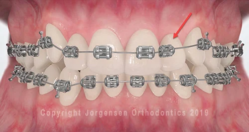 Orthodontic Emergencies: Problems With Your Braces | Jorgensen ...