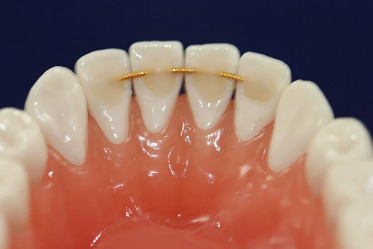 Are Bonded Retainers Right for You? | Jorgensen Orthodontics ...