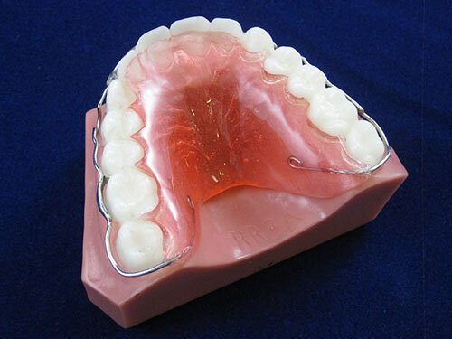 The Best Orthodontic Retainer for Your Top Teeth | Affordable Braces ...