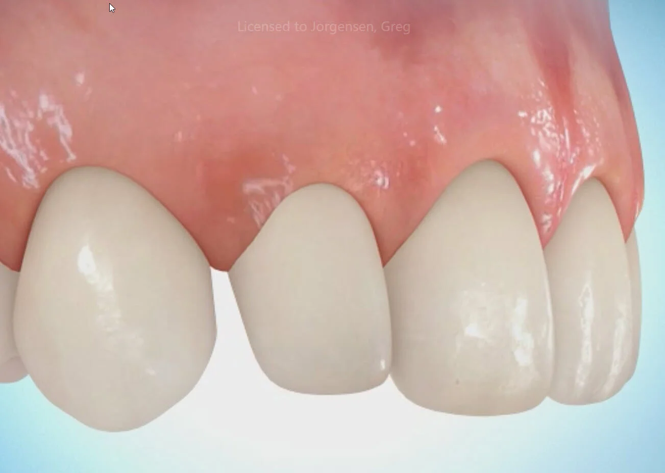 Closing Spaces Between Your Upper Front Teeth | Jorgensen Orthodontics ...