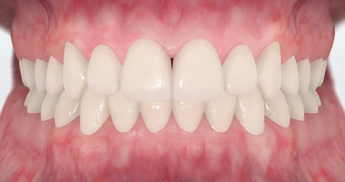 What Are Dark Triangles? | Jorgensen Orthodontics - Affordable Care