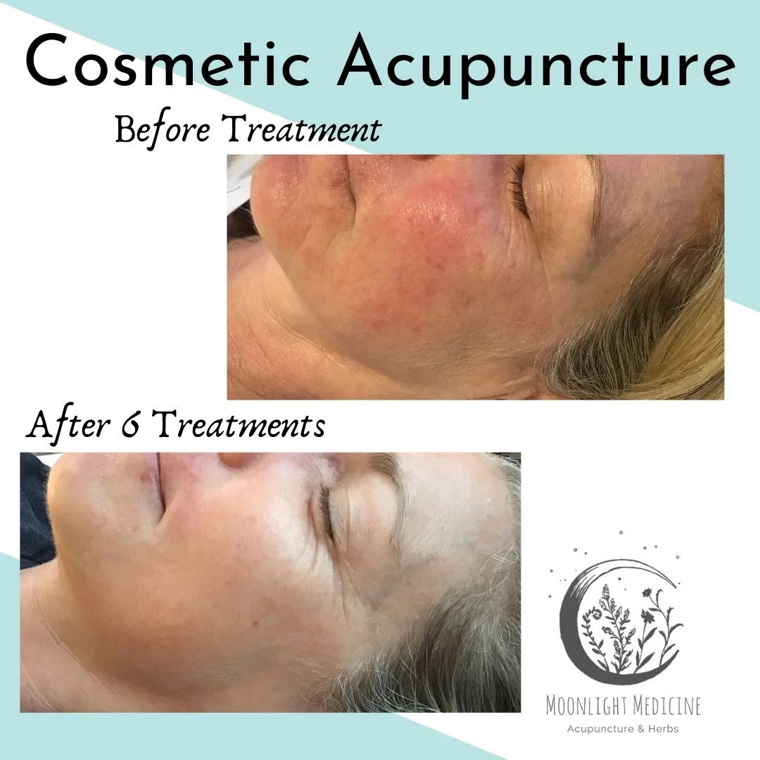 Cosmetic Acupuncture Before and After Photos — Moonlight Medicine