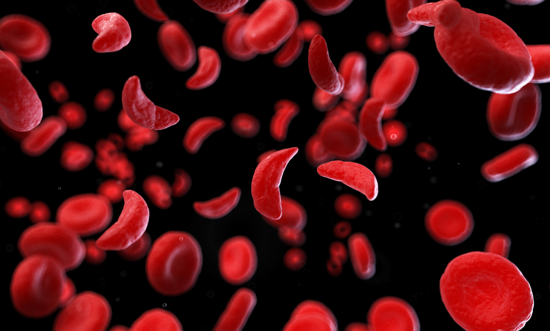 Sickle Cell Anemia
