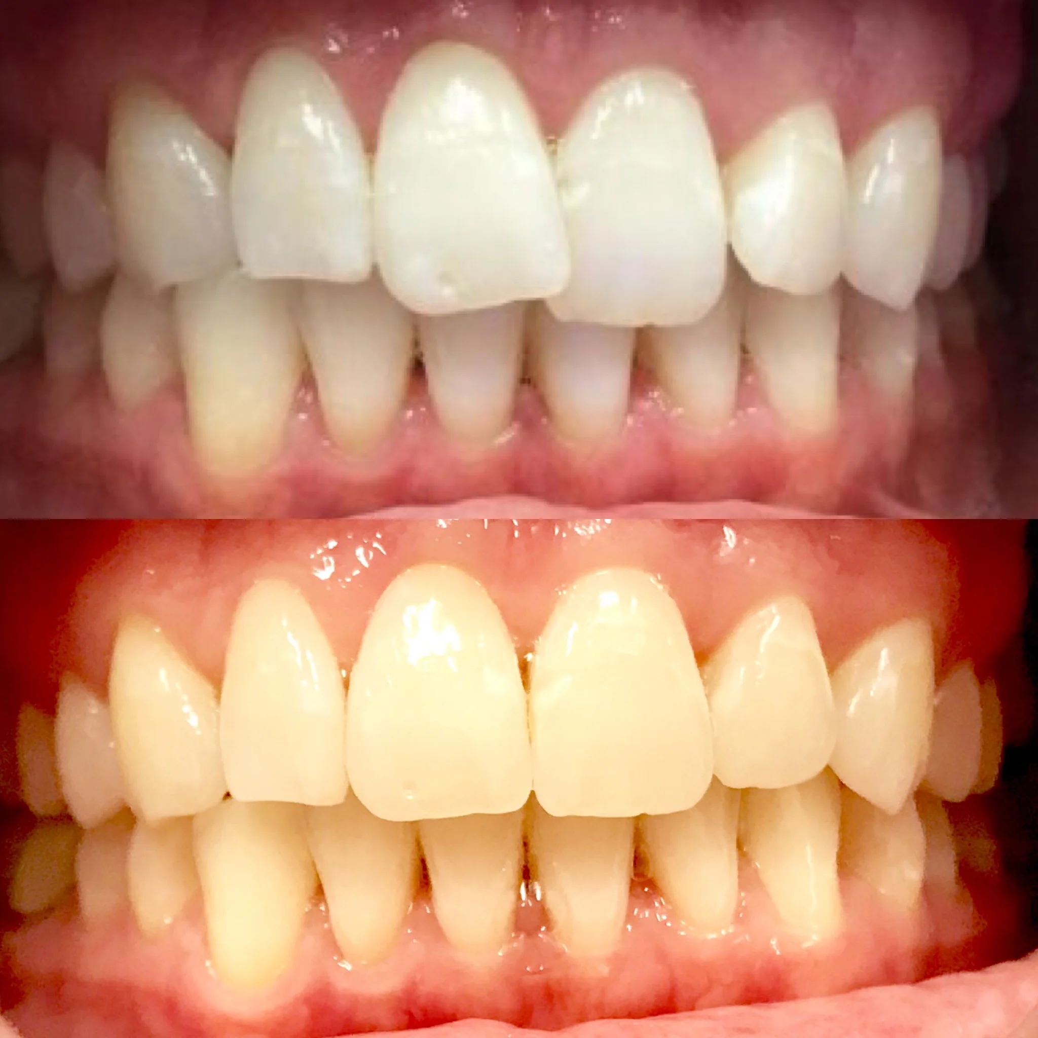 Invisalign Before And After Buck Teeth