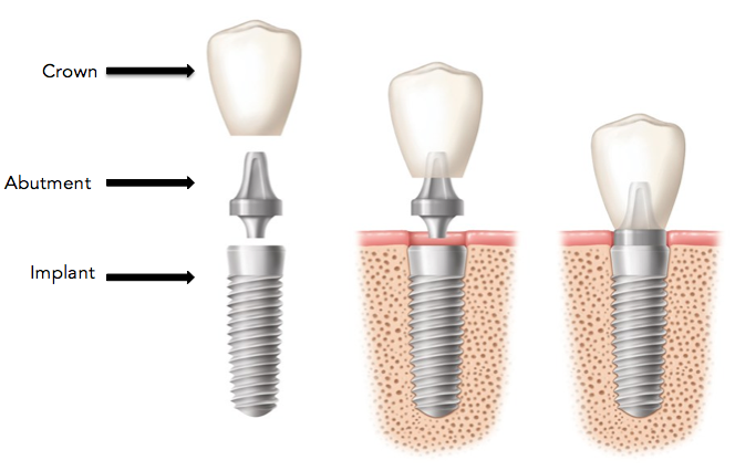 901 Dental Implants — 901 Dental
