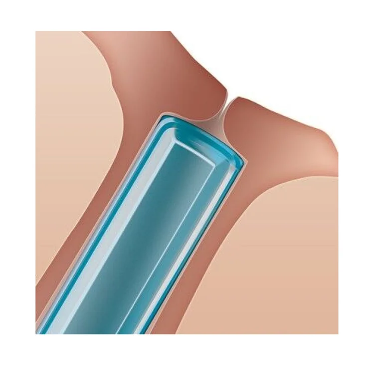 Punctal Plugs — SK Eyecare