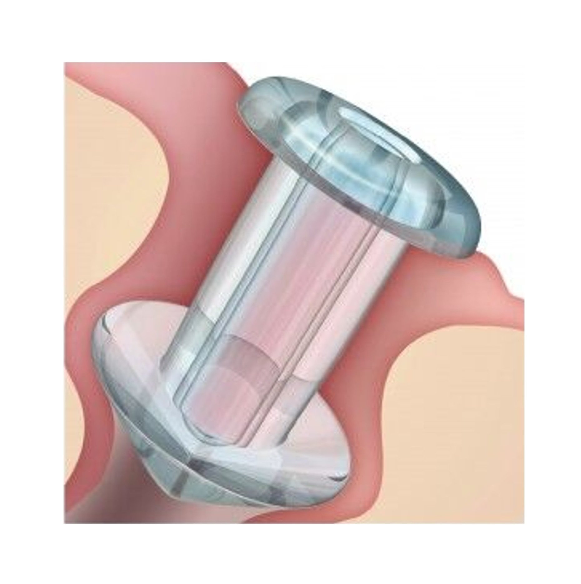 Punctal Plugs — SK Eyecare