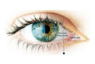 Punctal Plugs — SK Eyecare