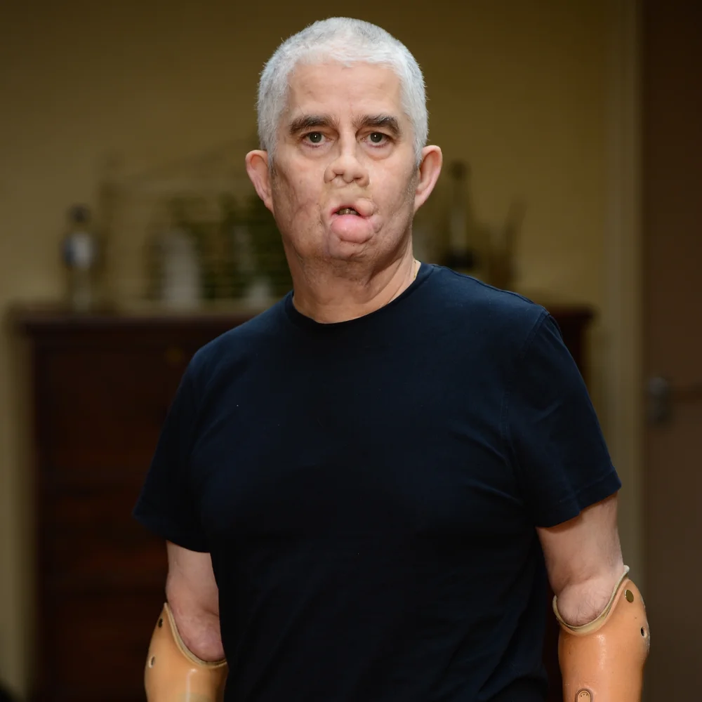 Stories — World Sepsis Day - September 13